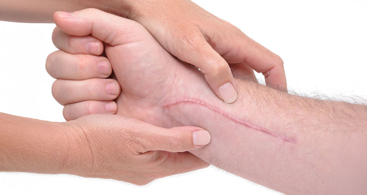 Scar Therapy: Silicone + Pressure = Silon-TEX® II