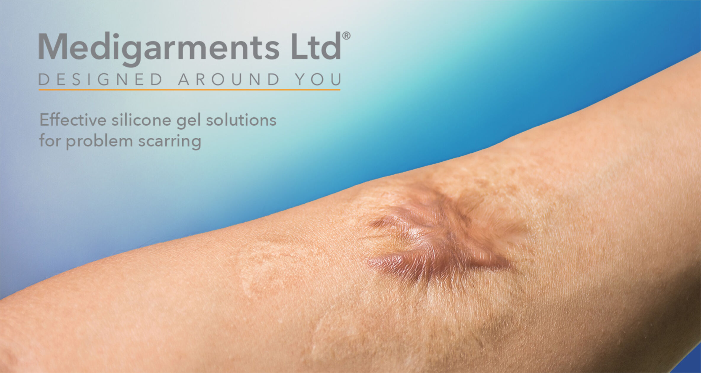 Silicone gel for the management of problem scarring